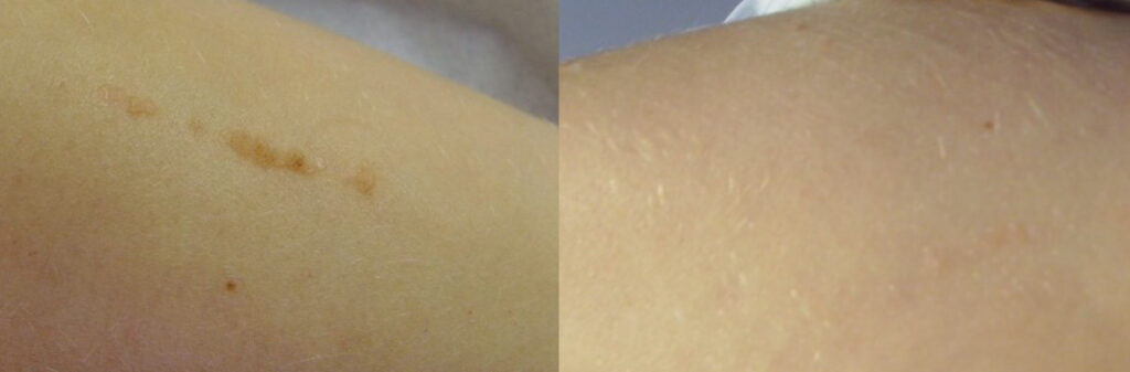 Was sind Keloide? Praxis Schwabing